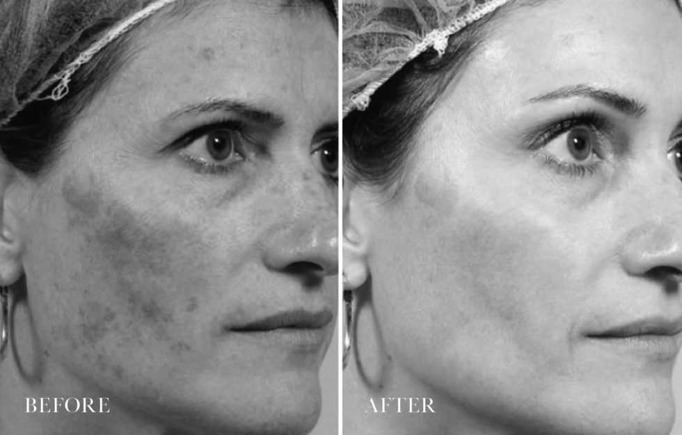 Frax 1550 in Richland - DermaCare TriCities